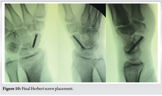 A Novel Technique for Percutaneous Herbert Screw Fixation in Acute ...