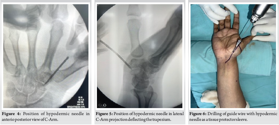 A Novel Technique for Percutaneous Herbert Screw Fixation in Acute ...