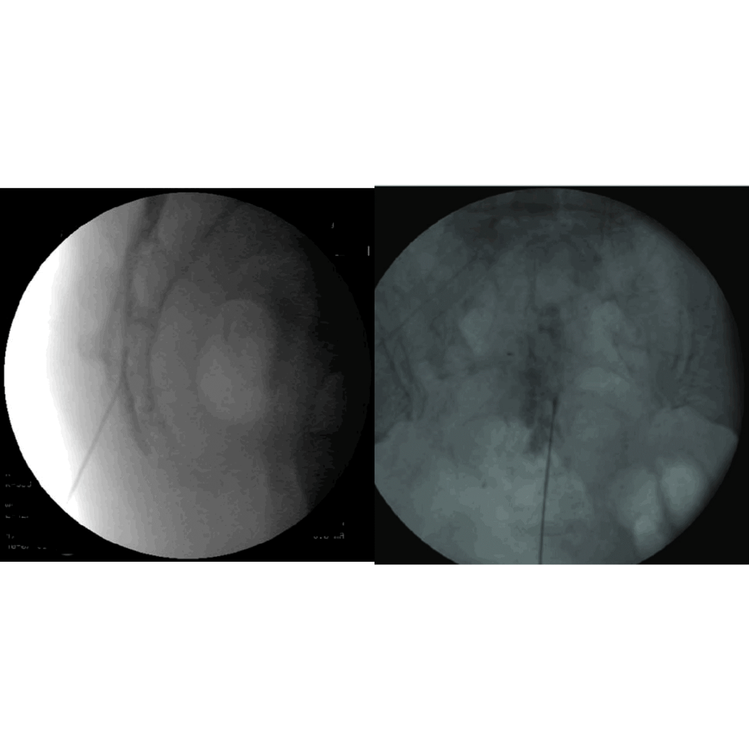 Effectiveness of Epidural Methylprednisolone Injection in Management of ...