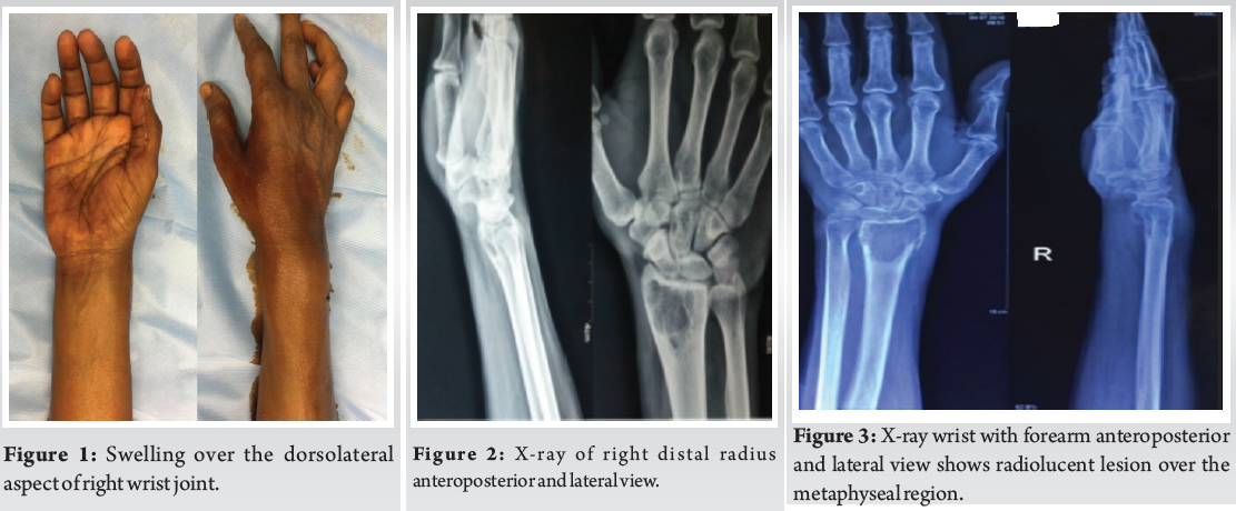 Giant Cell Tumor of Distal Radius Treated with Wide Local Excision and ...