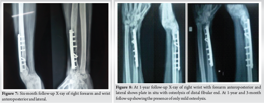 Giant Cell Tumor of Distal Radius Treated with Wide Local Excision and ...