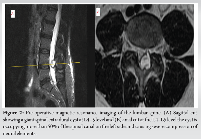 Full Endoscopic Resection of Giant Synovial Cyst in the Lumbar Spine: A ...