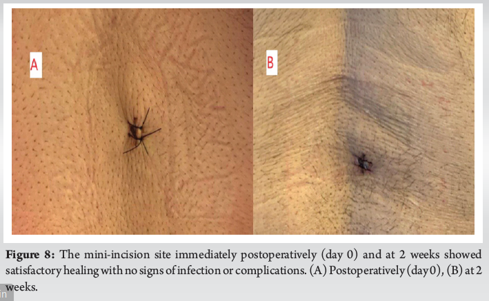 Full Endoscopic Resection of Giant Synovial Cyst in the Lumbar Spine: A ...
