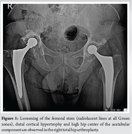 Revision of Total Hip Arthroplastys Using Short Femoral Stems: Is It ...