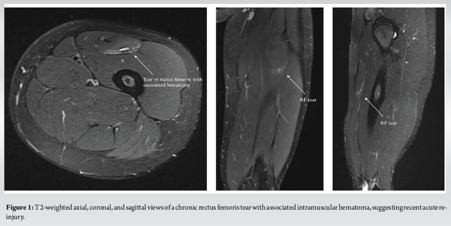 Operative Management of a Chronic Proximal Rectus Femoris Muscle Tear ...