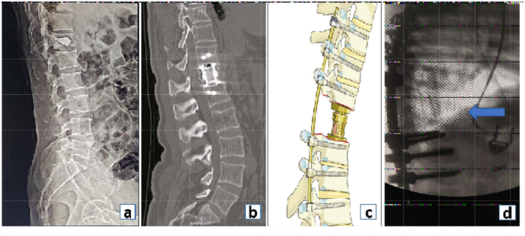 Fixation, Stabilization, Dynamic Stabilization, Fusion, and ...