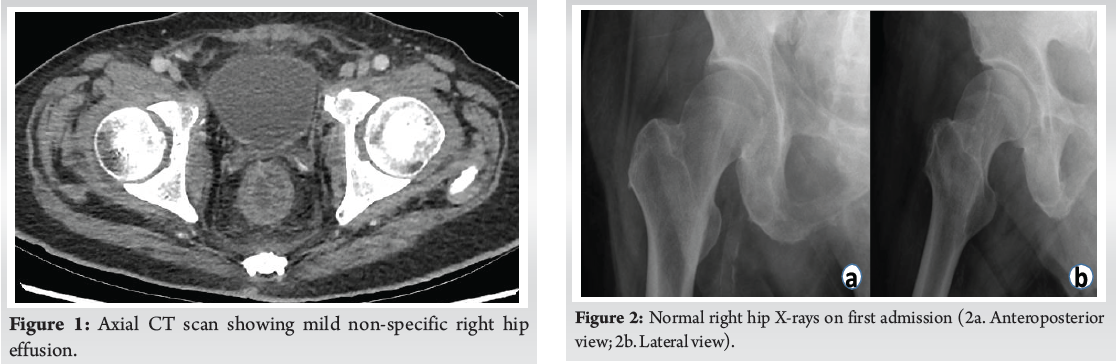 One and a Half-stage Total Hip Arthroplasty with Custom-Made ...