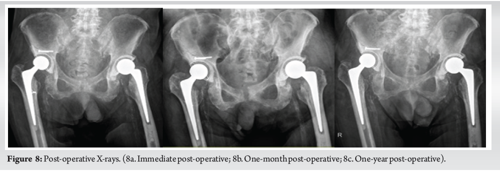 One and a Half-stage Total Hip Arthroplasty with Custom-Made ...