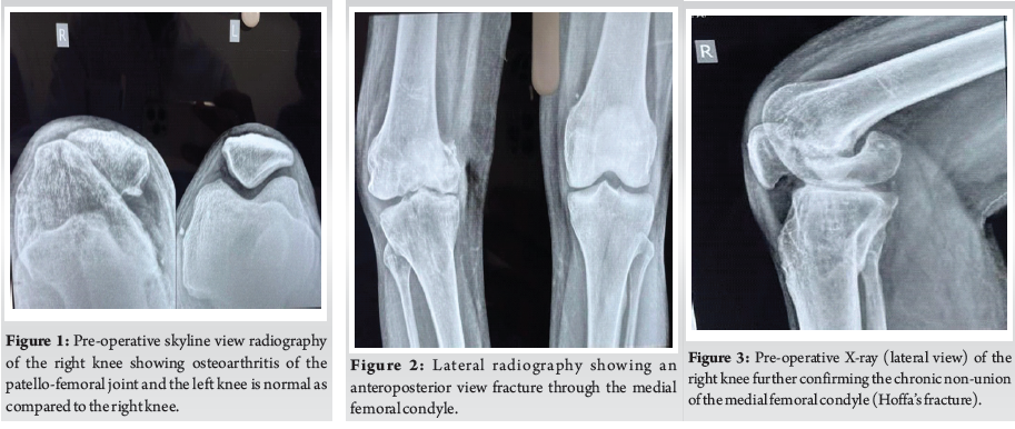 Non-union Hoffa’s fracture in an Adult Male managed with Total Knee ...