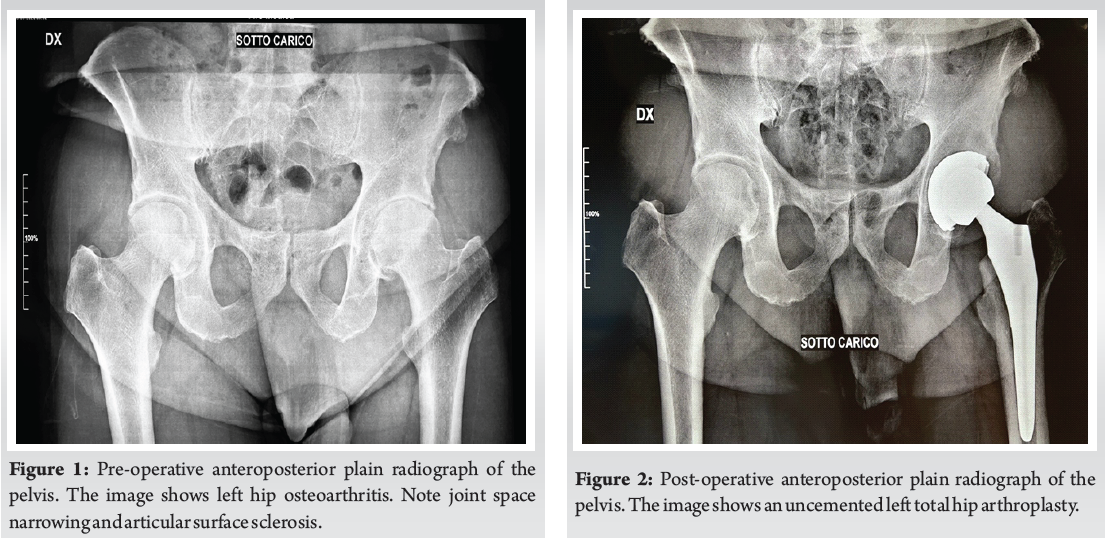 A Rare Case of Staphylococcus Caprae Periprosthetic Hip Infection with ...