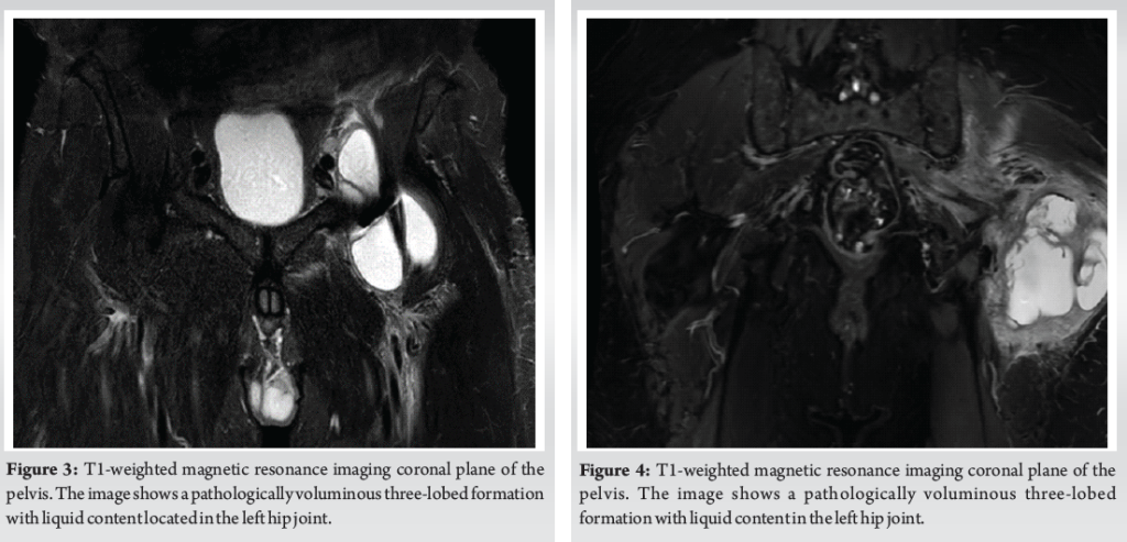 A Rare Case of Staphylococcus Caprae Periprosthetic Hip Infection with ...