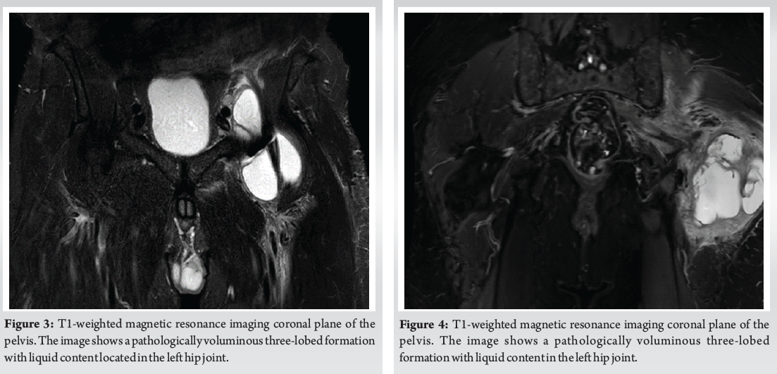 A Rare Case of Staphylococcus Caprae Periprosthetic Hip Infection with ...