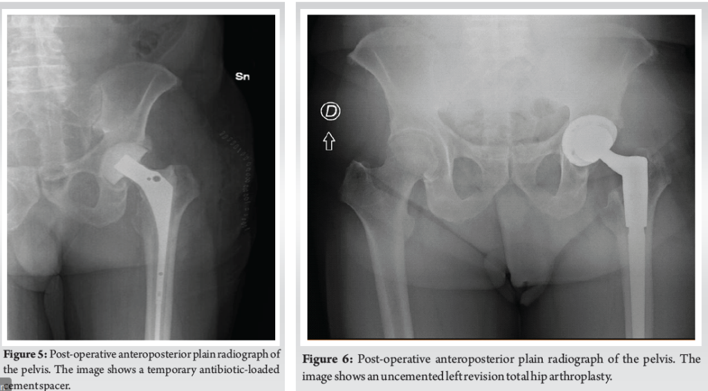 A Rare Case of Staphylococcus Caprae Periprosthetic Hip Infection with ...