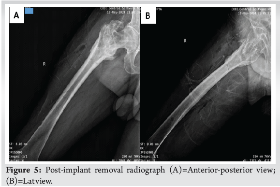 Healing Against the Odds: Successful Bone Union in Intertrochanteric ...