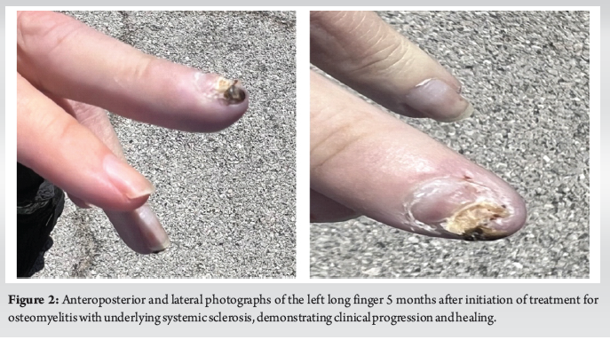 Systemic Sclerosis Presenting as Osteomyelitis of the Finger ...