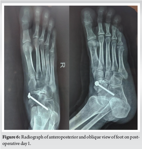 Chronic Midfoot Pain Due to Idiopathic Osteonecrosis of Tarsal ...
