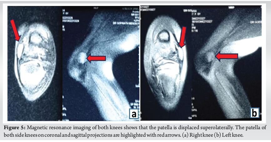 Femoral Shortening Osteotomy in Managing Congenital Patellar ...