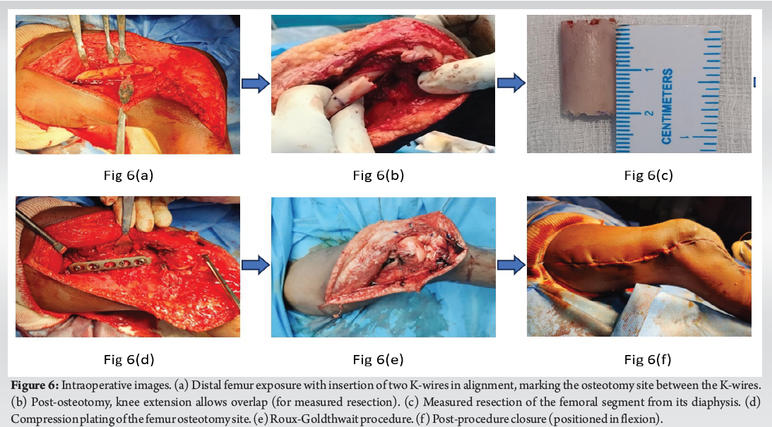 Femoral Shortening Osteotomy in Managing Congenital Patellar ...