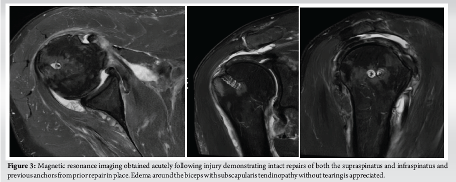 Traumatic Inferior Shoulder Dislocation with Posterior Cord Brachial ...