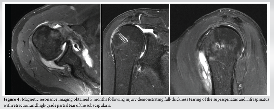 Traumatic Inferior Shoulder Dislocation with Posterior Cord Brachial ...