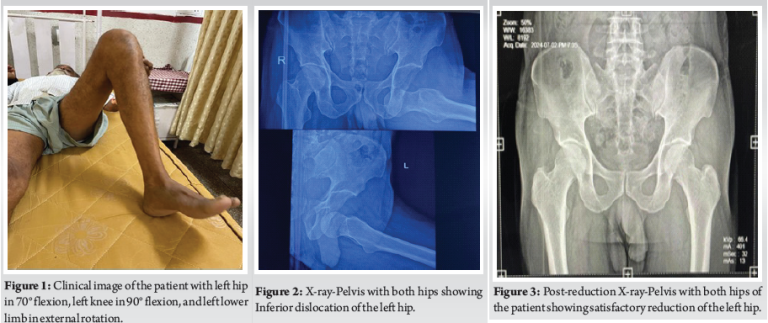 Inferior Hip Dislocation – A Case Report and Literature Review ...
