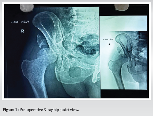 Total Hip Arthroplasty with Cage Application for Complex Posterior Hip ...