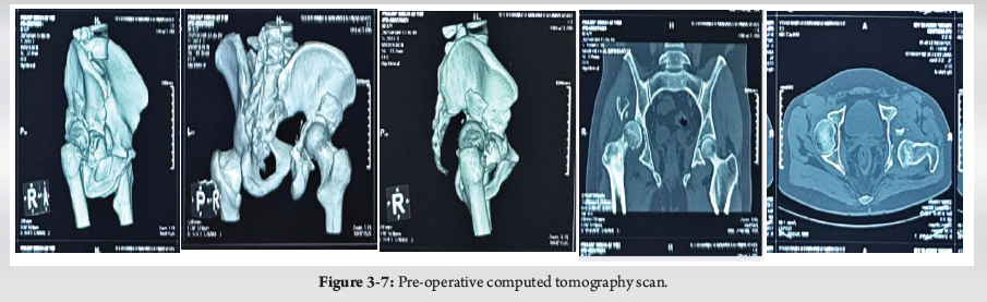 Total Hip Arthroplasty with Cage Application for Complex Posterior Hip ...