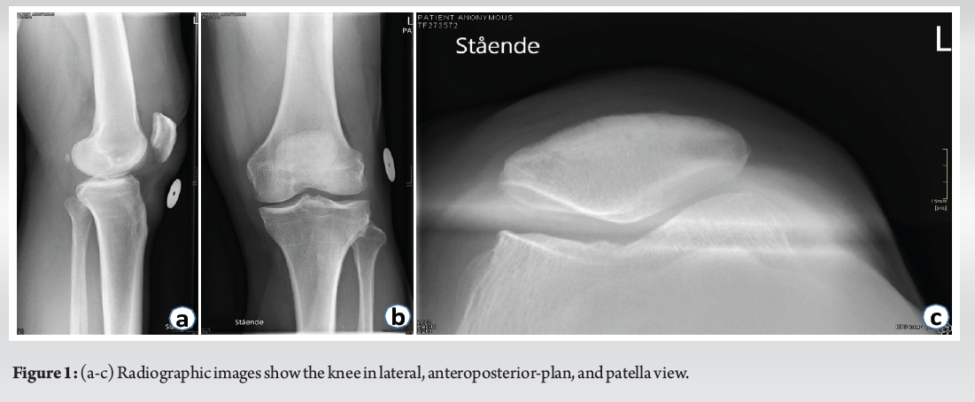 Kingella kingae Induced Septic Arthritis in the Knee Revealing an ...