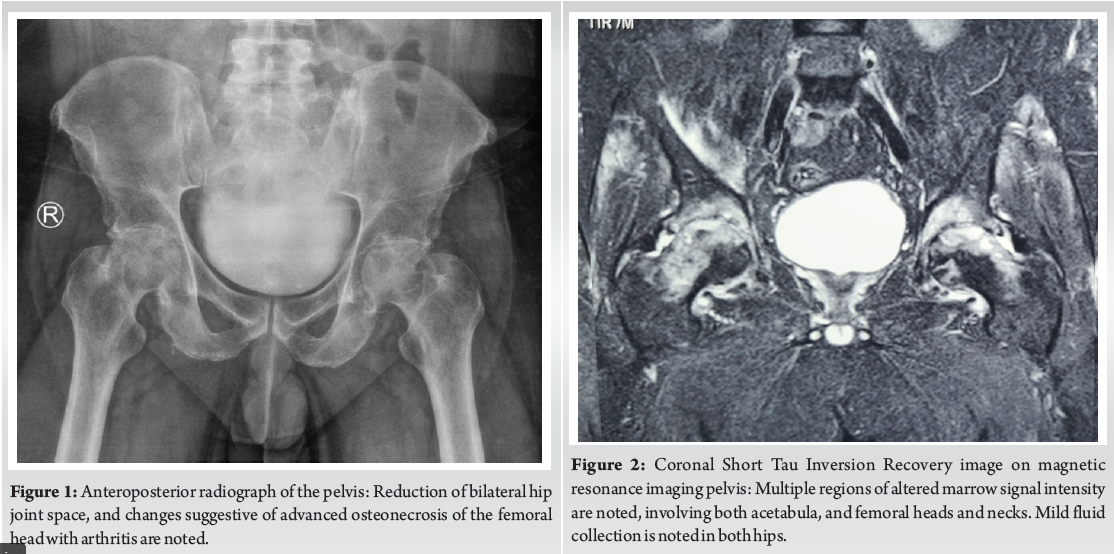 Osteonecrosis with Concomitant Septic Arthritis of Bilateral Hips ...