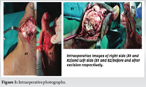 Gouty Arthritis with Massive Tophaceous Deposits Involving Bilateral ...