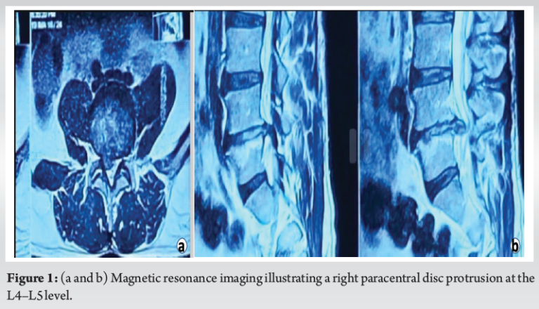 Transformative Spinal Surgery: Lateral Position Unilateral Biportal ...