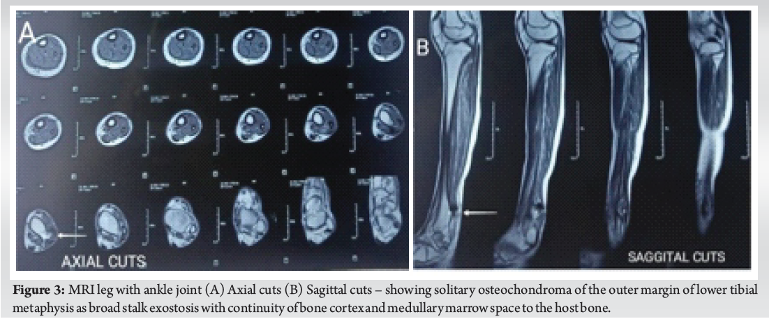 Challenges and Solutions in Managing Recurrent Distal Tibia ...