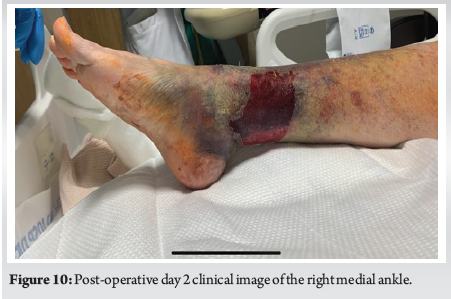 Intramedullary Fibular Nail Fixation in an Elderly Patient with a ...