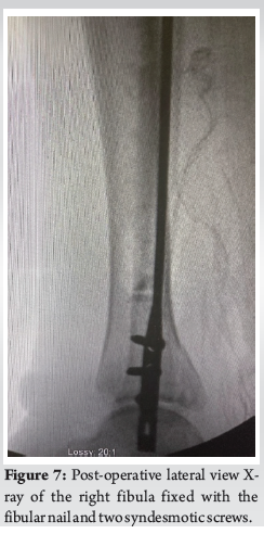 Intramedullary Fibular Nail Fixation in an Elderly Patient with a ...