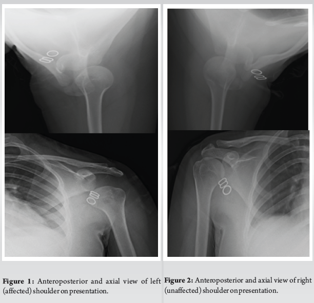 Atypical Idiopathic Inferior Functional Shoulder Instability in a 15 ...