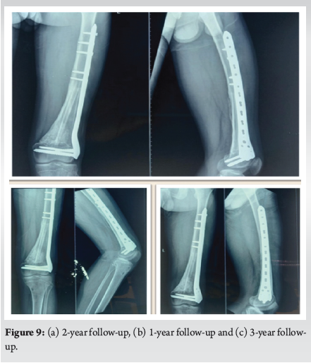 Comprehensive Management of Distal Femur Osteosarcoma in a 15-year-old ...