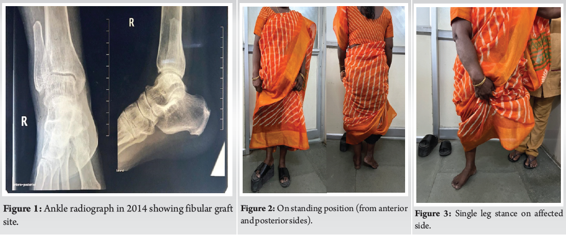 The Journey of an Ankylosed Hip: A 20 Year Long-Term Follow-up of an ...