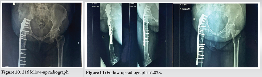 The Journey of an Ankylosed Hip: A 20 Year Long-Term Follow-up of an ...