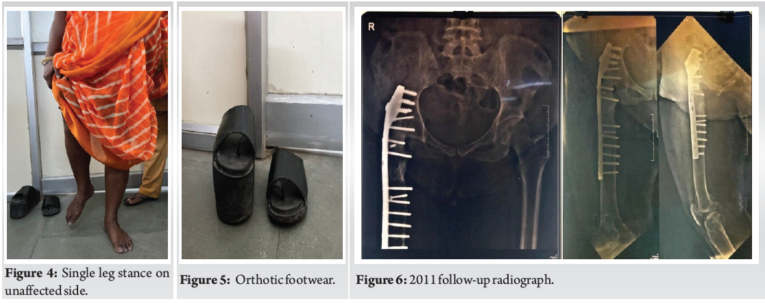 The Journey of an Ankylosed Hip: A 20 Year Long-Term Follow-up of an ...