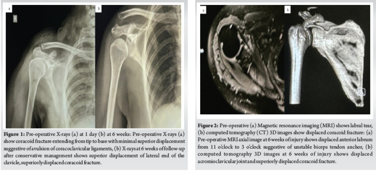 Late Presentation of Acromioclavicular Joint Dislocation with Double ...