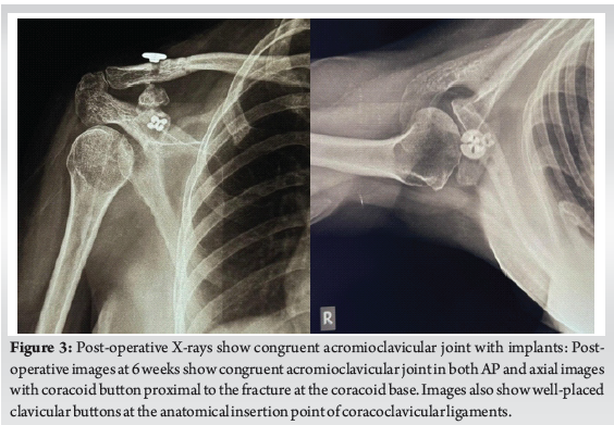 Late Presentation of Acromioclavicular Joint Dislocation with Double ...