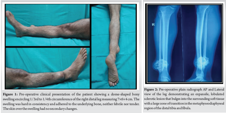 Aneurysmal Bone Cyst of the Distal Ulna in an Elderly Lady | Journal of ...
