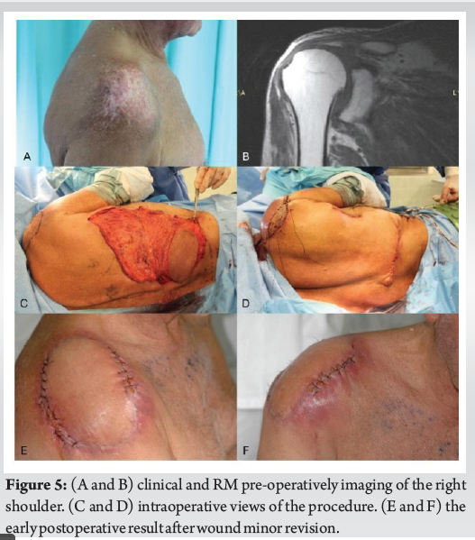 The Controversial Late Effect of Shoulder Radiation Therapy in a Small ...