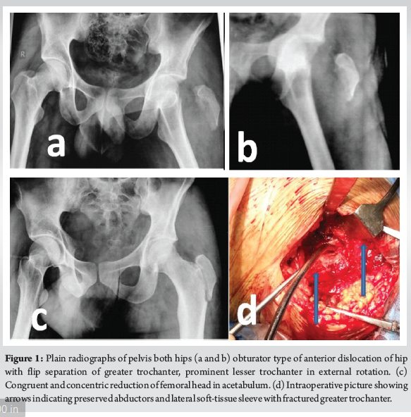 Traumatic Greater Trochanteric Avulsion with Obturator Dislocation of ...