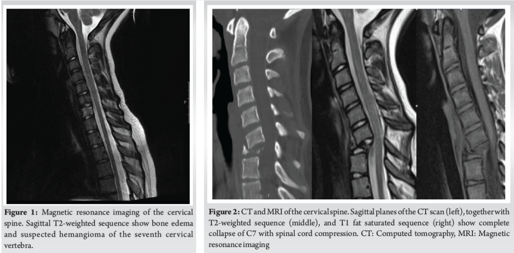Surgical Interventions in Chronic Recurrent Multifocal Osteomyelitis ...