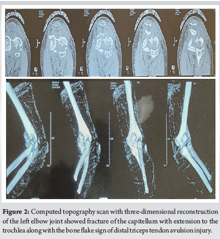 Capitellum Fracture with Distal Triceps Tendon Avulsion Injury: A Rare ...
