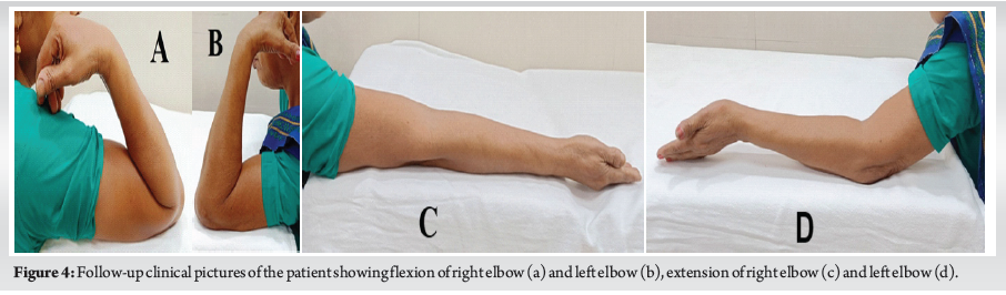 Capitellum Fracture with Distal Triceps Tendon Avulsion Injury: A Rare ...