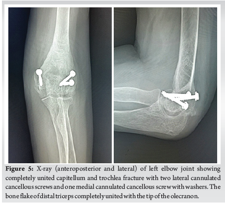 Capitellum Fracture with Distal Triceps Tendon Avulsion Injury: A Rare ...