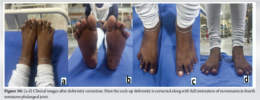 A Modified Deformity Correction Method for Congenital Brachymetatarsia ...