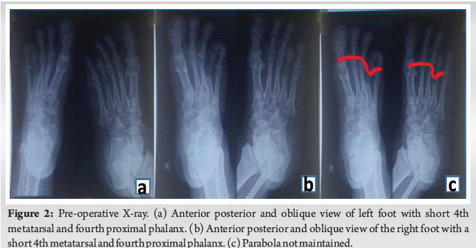 A Modified Deformity Correction Method for Congenital Brachymetatarsia ...